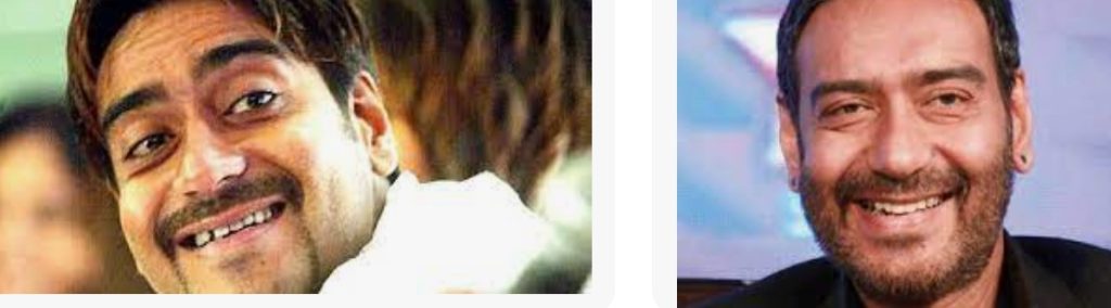 25 Indian Celebrities With Dental Implants *Beautiful Smiles NOW!*